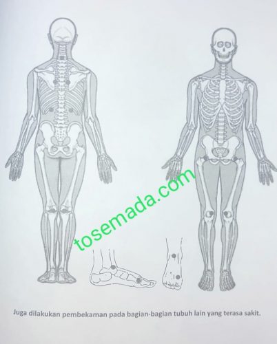 TITIK BEKAM ASAM URAT YANG PALING EFEKTIF OBATI ASAM URAT - Tosemada.com